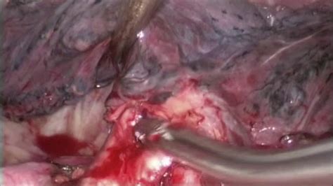 Uniportal Left Upper Lobe Lobectomy With Partial Pleurectomy Youtube
