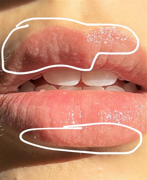 Itchy Lip Bumps Oozing Clear Fluid Not Cold Sores HELP R Accutane