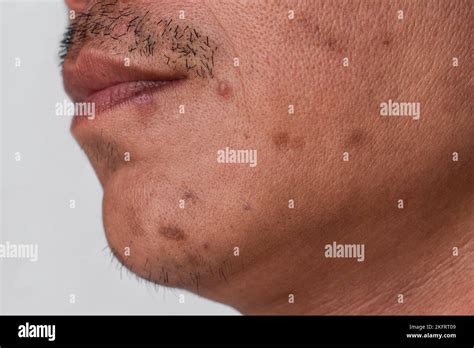 Small Brown Patches Called Age Spots And Scars On The Face Of Asian Man