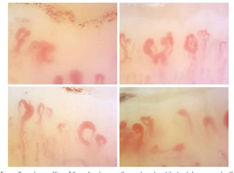 Figure 1 From A Practical Overview Of The Role Of Capillaroscopy In