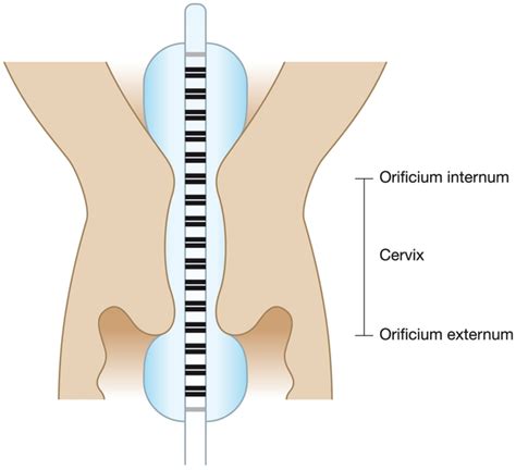 Internal Cervical Os Model Canal
