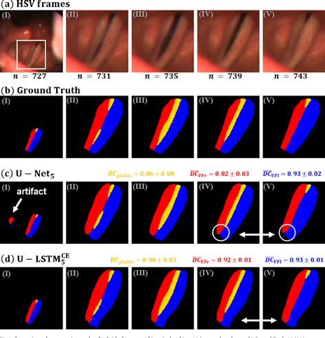 Figure 3 From Fully Automatic Segmentation Of Glottis And Vocal Folds In Endoscopic Laryngeal