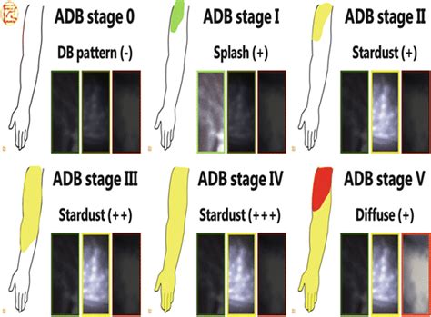 Comprehensive Lymphedema Evaluation Using Dynamic ICG Lymphography Radiology Key