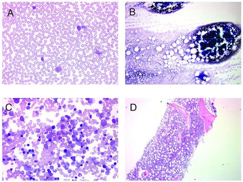 Jak1 Somatic Mutation In A Myeloproliferative Neoplasm Haematologica