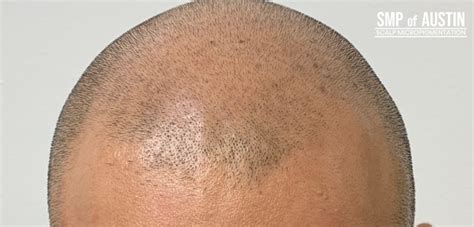 Hair Transplant Scars Can Be Covered With Scalp Micropigmentation Smp Hair Transplant Scars Can Be Covered With Scalp Micropigmentation Smp