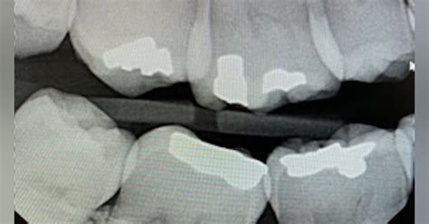 Techniques To Reduce Horizontal Overlap In Dental X Rays Registered Dental Hygienists