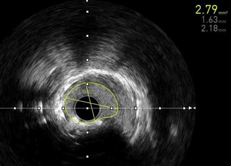 Case Complex Multivessel PCI Cardiology Apps
