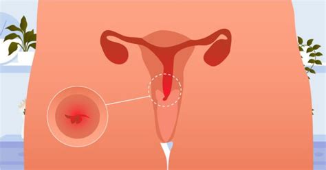 How To Prevent Vaginal Bleeding After Sex No More Mess