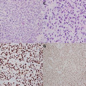 Histopathology Of Diffuse Midline Glioma DMG H K M Altered With Download Scientific Diagram