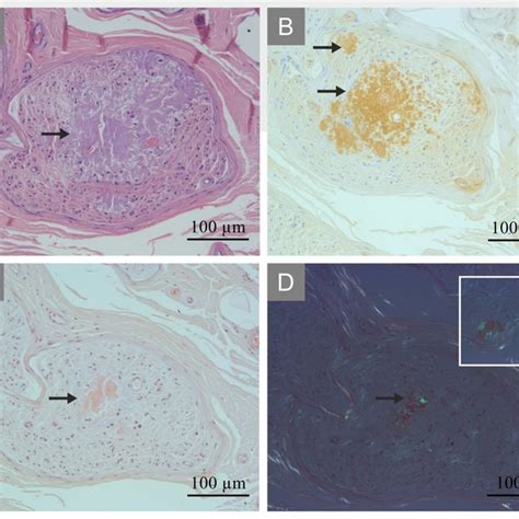 Representative Characteristics Of Amyloid Deposition In Sural Nerve