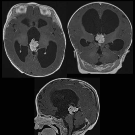 Pediatric Choroid Plexus Papilloma Pediatric Radiology Reference