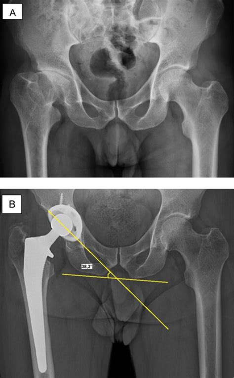 Acetabular Component Inclination In Relation To The Pelvis Download Scientific Diagram