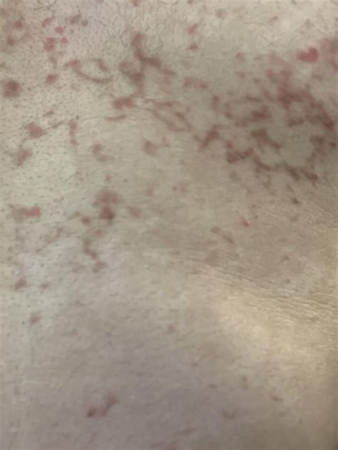 Rash Protocol Update Kinda Long R Candida