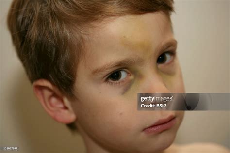 Discharge Of A Hematoma On The Forehead At The Level Of The Eyes