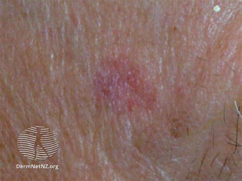 Basal Cell Carcinoma Affecting The Face Dermnet Nz Lesions Bcc Face