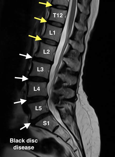 Herniated Disc Mri Scan