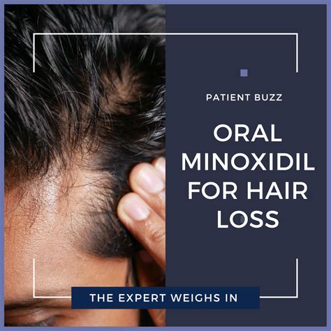 Oral Minoxidil for Hair Loss | The Expert Weighs In - Next Steps in ...