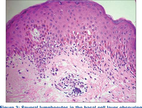 Figure 13 From Interface Dermatitis Semantic Scholar