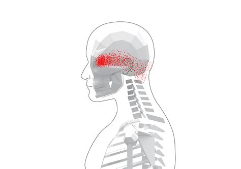 Splenius Cervicis Trigger Points Overview Self Treatment Tips