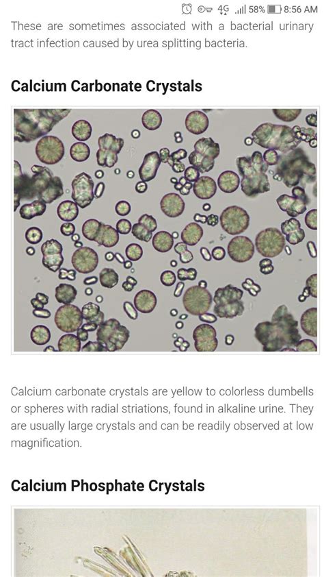 Calcium Carbonate Crystals In Urine