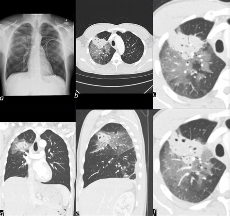 311lu Staph Aureus Cavitating Pneumonia Following Influenza Infection The Common Vein