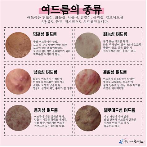 우아미한의원 여드름종류여드름면포결절성여드름응괴성여드름사당압출사당여드름방배압출방배여드름고터압출고터여드름