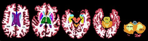 Example Of Fully Automated Segmentation Of The Brain And Brainstem