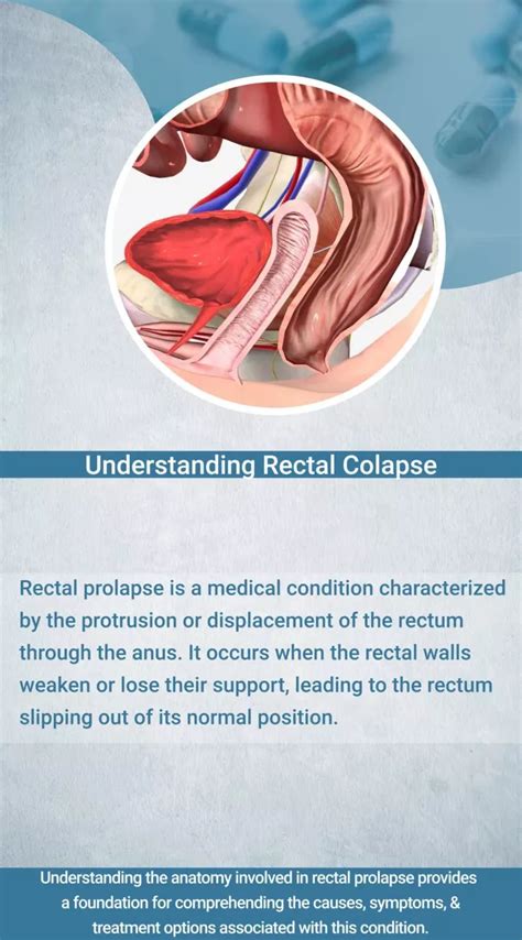 Ppt Rectal Prolapse Symptoms Causes Diagnosing And Treatment