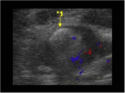 Musculoskeletal Joints And Tendons 6 5 Hip Groin And Buttock Case 6 5 6 Aneurysms
