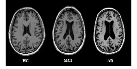 Axial View Of Hc Mci And Ad Download Scientific Diagram