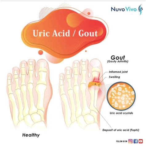 Uric Acid Gout Artofit