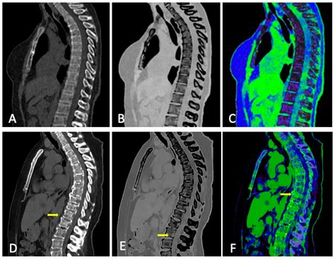 Imaging Of Multiple Myeloma Present And Future