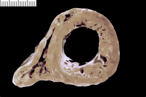 Left Ventricular Noncompaction Cardiomyopathydilated Note The Left Download Scientific