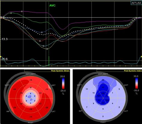 Different Options Of Displaying Speckle Tracking Derived Information In