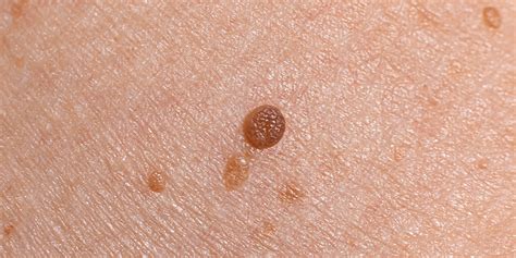 Hpv Human Papillomavirus Infectious Disease Of The Palm Beaches