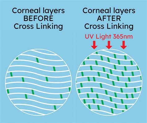 Managing Keratoconus Isurgeon