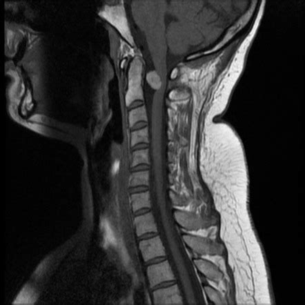 Malignant Melanotic Nerve Sheath Tumor Radiology Case