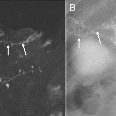 Biliary Necrosis As A Manifestation Of Ischemic Cholangiopathy In A Download Scientific Diagram