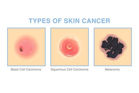 Basal Cell Carcinoma Stages Pictures Guide