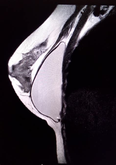 breast implant mri teaching points sumer s radiology blog