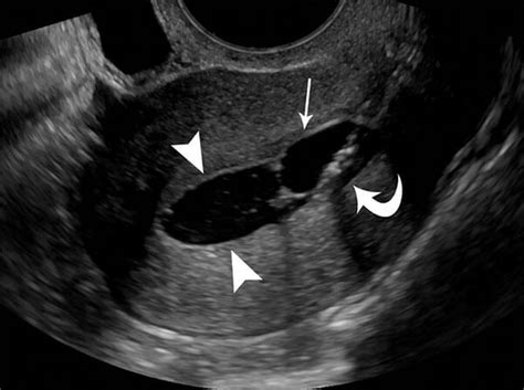 Ultrasound Of The Pelvis Shows A Normal Uterus
