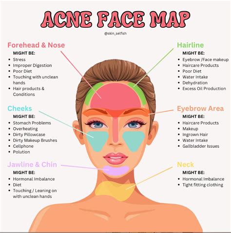 Acne Face Map What Your Acne Means Face Mapping Acne Face Acne Acne