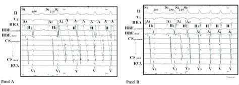 Intracardiac Electrocardiogram In A Typical Case In Which Atrial Download Scientific Diagram