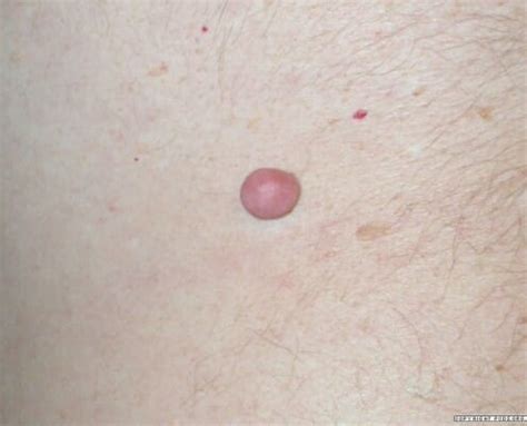 Neurofibroma South East Skin Clinic
