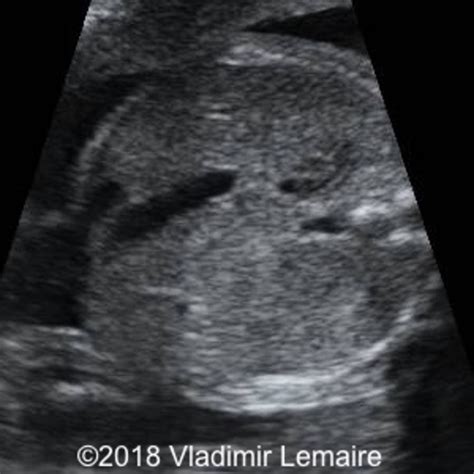 📃 Persistent Right Umbilical Vein