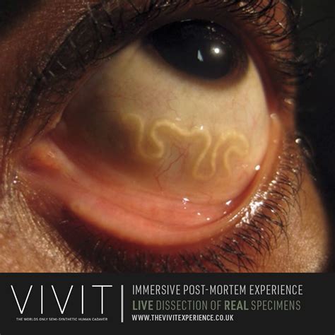 Are Parasites Visible To The Human Eye At Chris Moody Blog