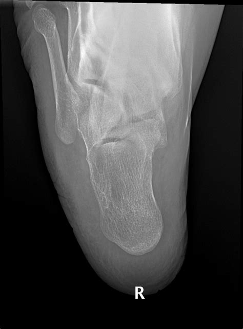 Calcaneal Intraosseous Lipoma Image