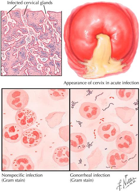 Cervicitis Clinical Tree