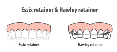Hawley Retainer Usage Process And Benefits Dr Joy Dental Clinic