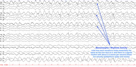 Eeg Terminology And Waveforms Eeg Terminology And Waveforms